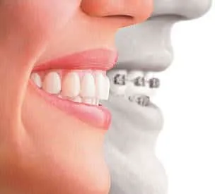 Braces Westminster CA, Teeth Braces, Metal Braces